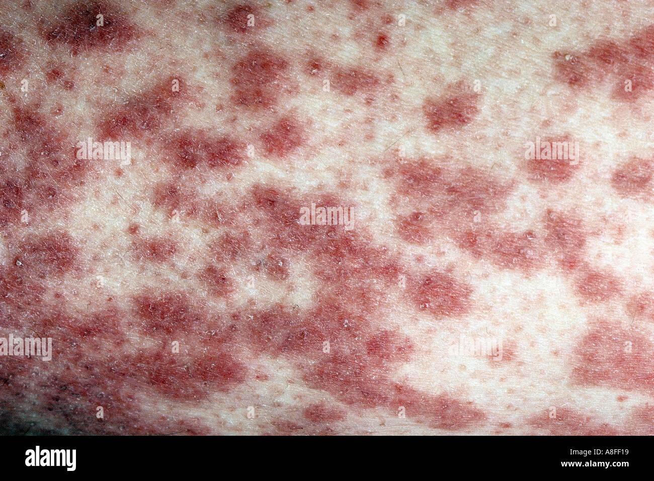 Erythema multiforme -Fotos und -Bildmaterial in hoher Auflösung – Alamy