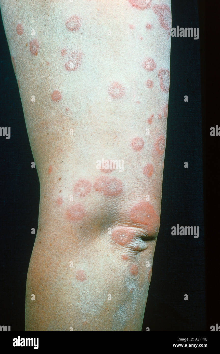 Erythema multiforme -Fotos und -Bildmaterial in hoher Auflösung – Alamy