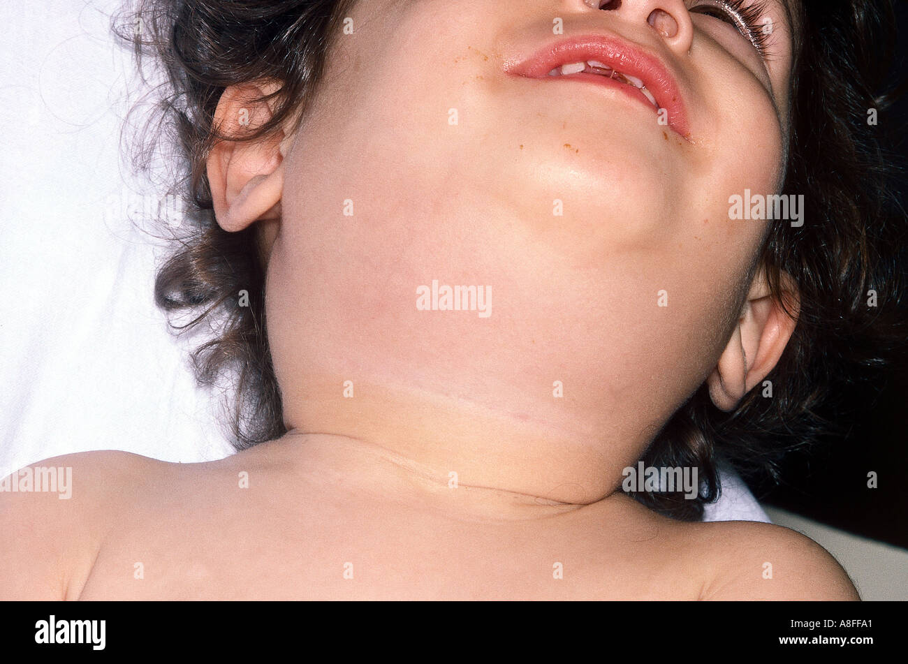Geschwollene parotis -Fotos und -Bildmaterial in hoher Auflösung – Alamy