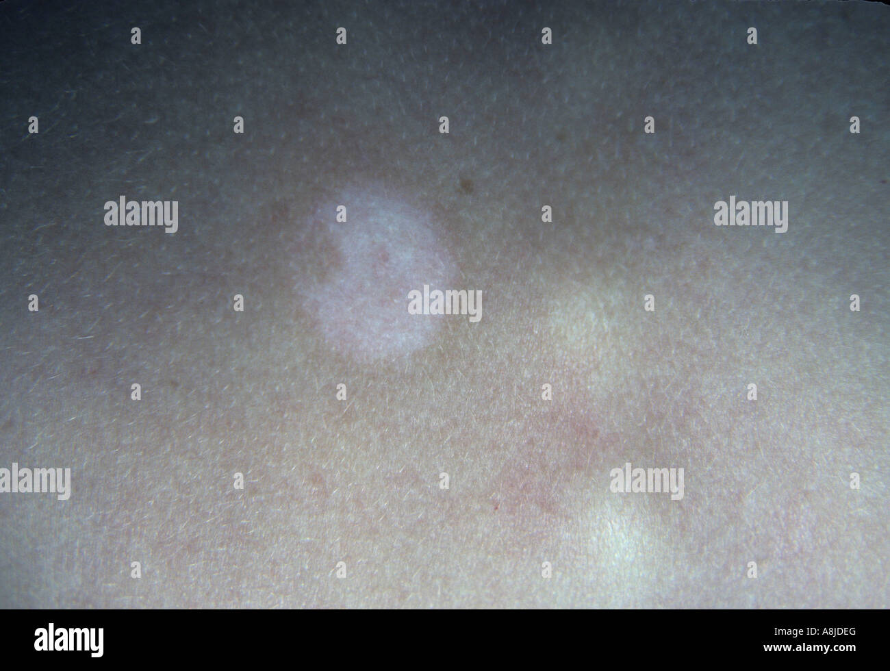 Gutartiger hauttumor -Fotos und -Bildmaterial in hoher Auflösung – Alamy
