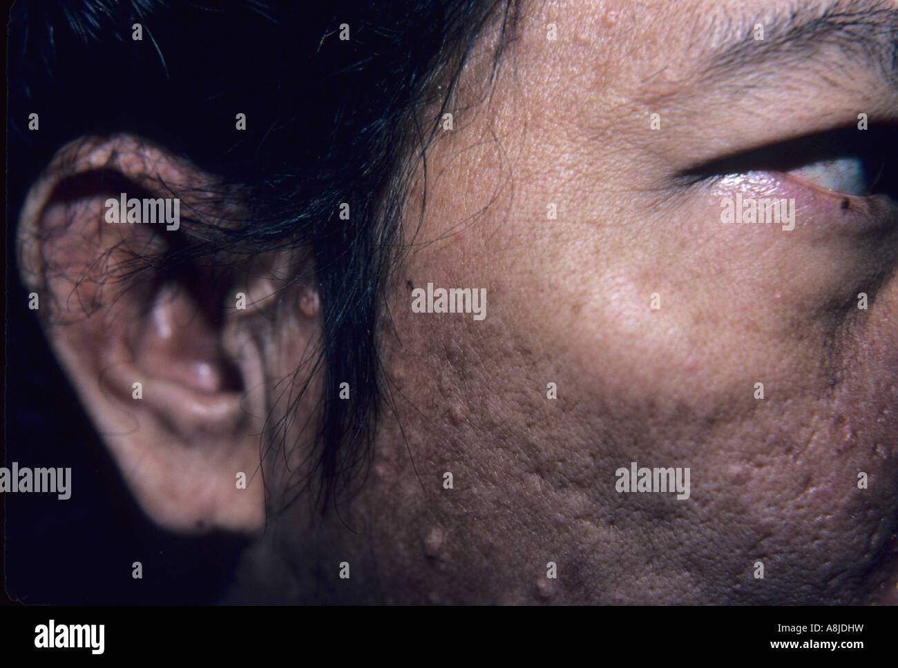 Cysts acne -Fotos und -Bildmaterial in hoher Auflösung – Alamy