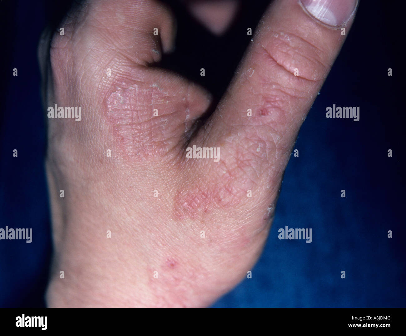 Pilzinfektion genannt Tinea Manus auf der Hand. Auch bekannt als ...