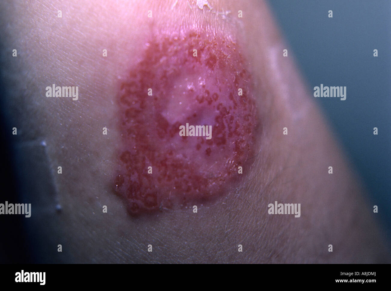Hautausschlag von einem Herpes-Simplex-Virus Stockfotografie - Alamy