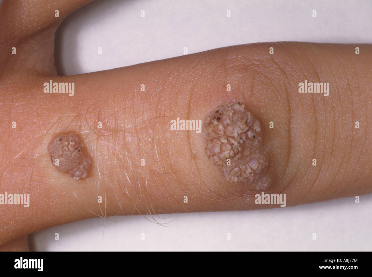 Gemeinsame Warzen durch HPV, humanes Papilloma-Virus verursacht ...
