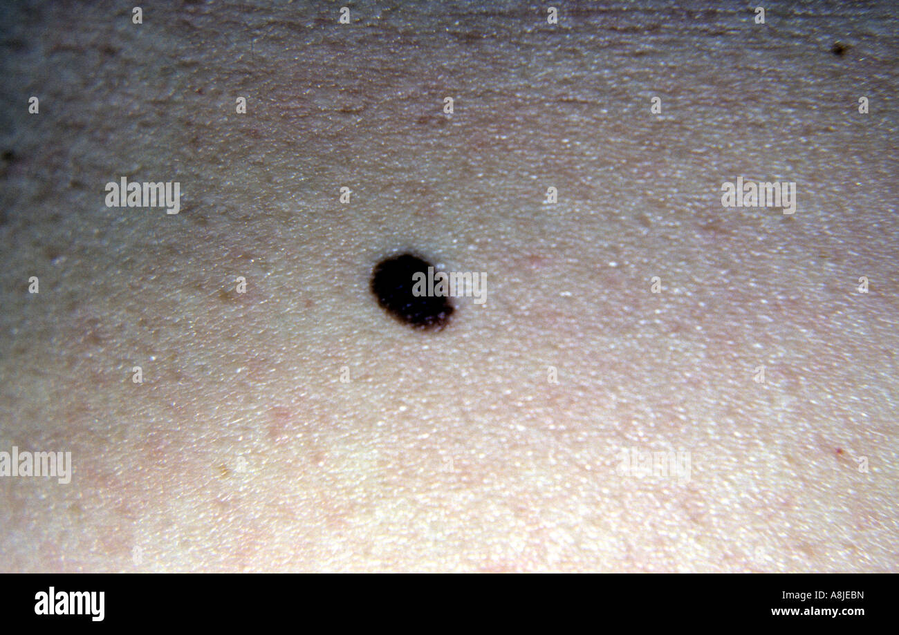 Dermatology Cmsp Stockfotos und -bilder Kaufen - Alamy