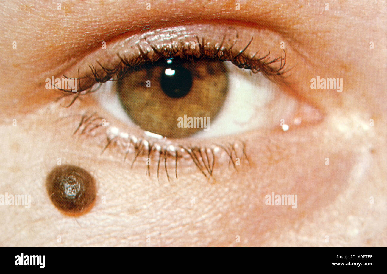 Pigmented naevus -Fotos und -Bildmaterial in hoher Auflösung – Alamy