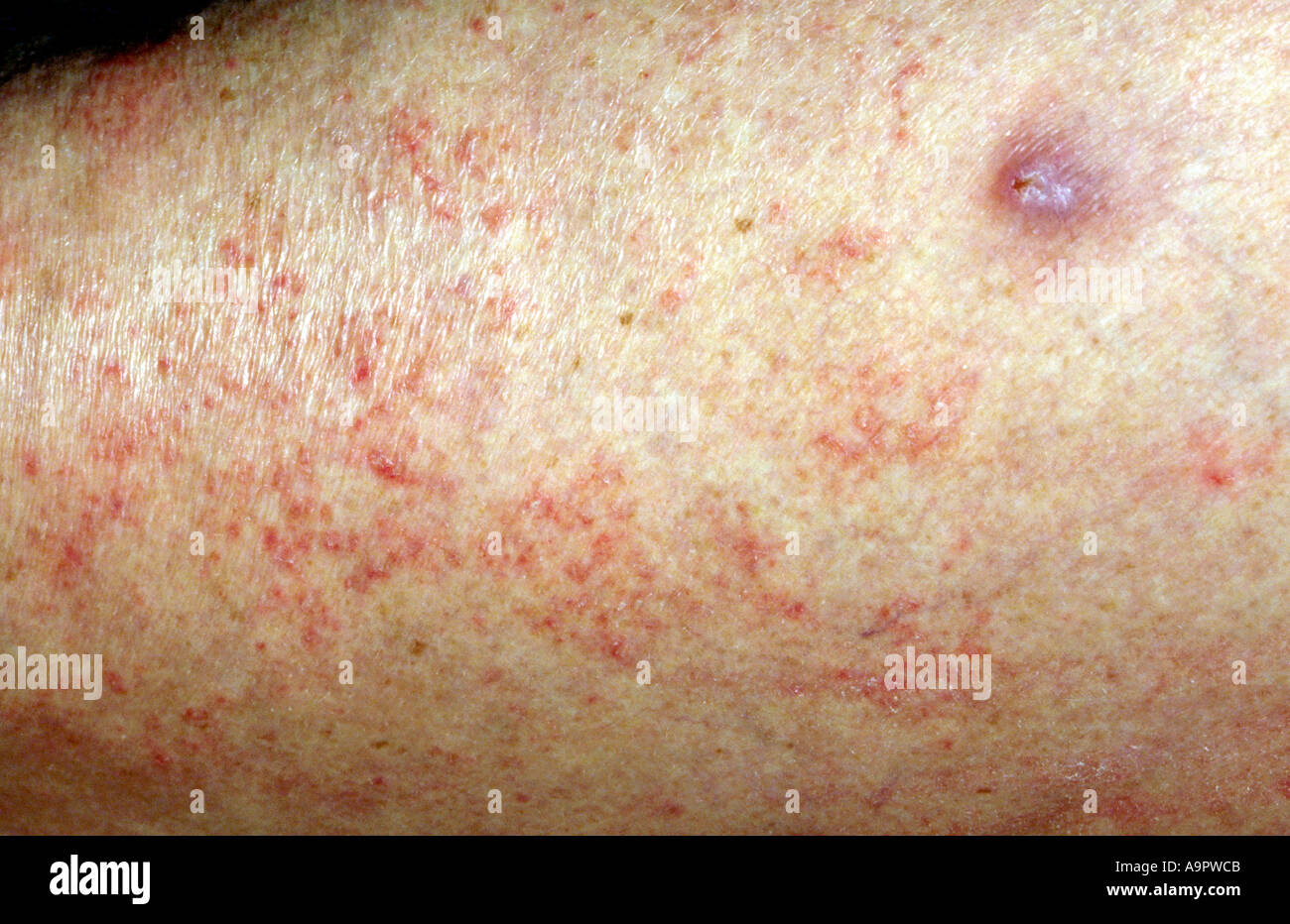 Scabies Mite Stockfotos & Scabies Mite Bilder - Alamy