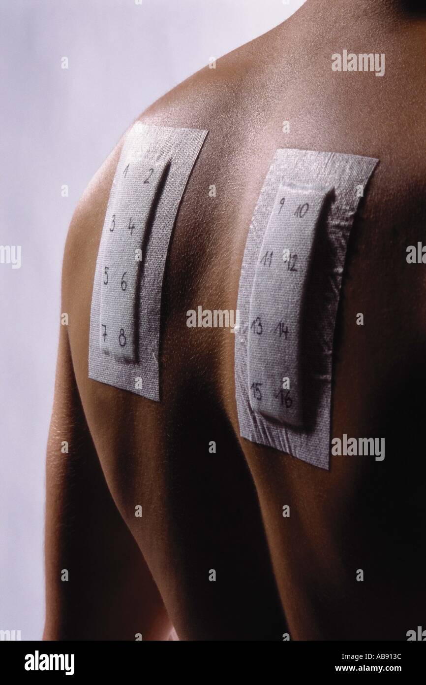 Allergy Test Back Stockfotos & Allergy Test Back Bilder - Alamy