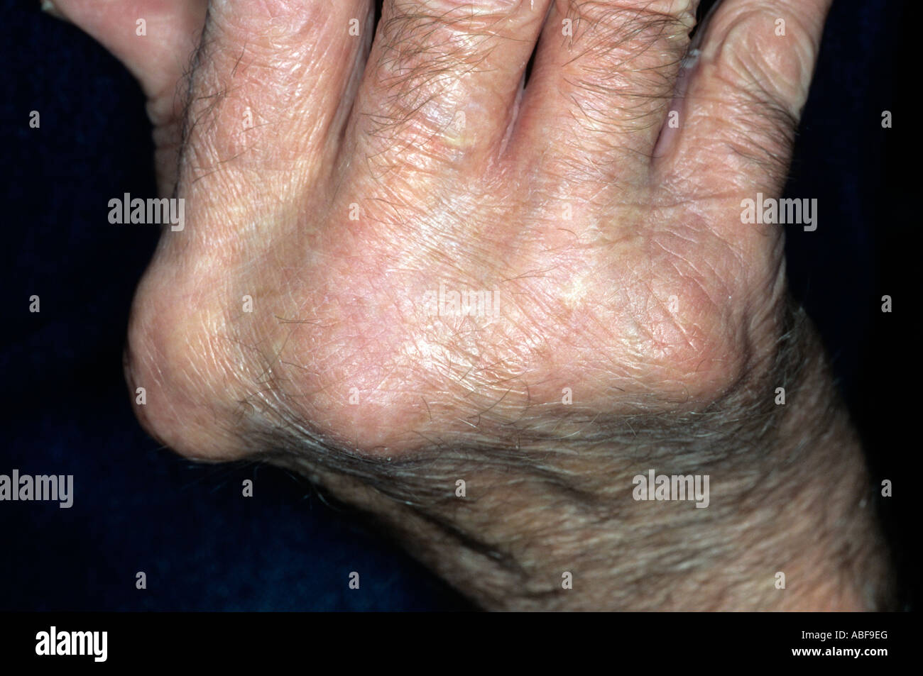 geschwollene Mittelhandknochen Phalangen Gelenke mit ulnaren Abweichung ...