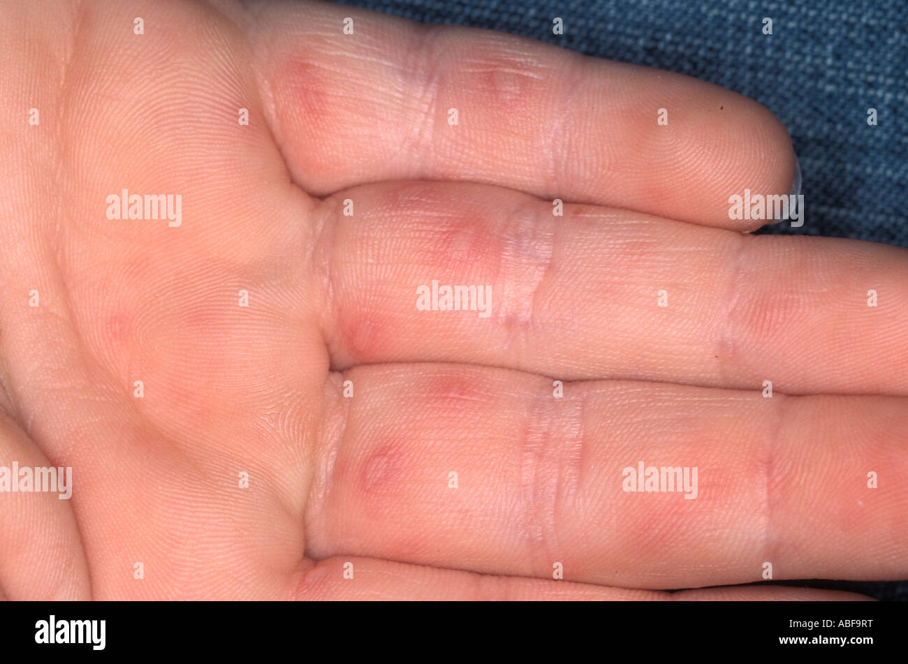 Coxsackievirus infektion -Fotos und -Bildmaterial in hoher Auflösung ...