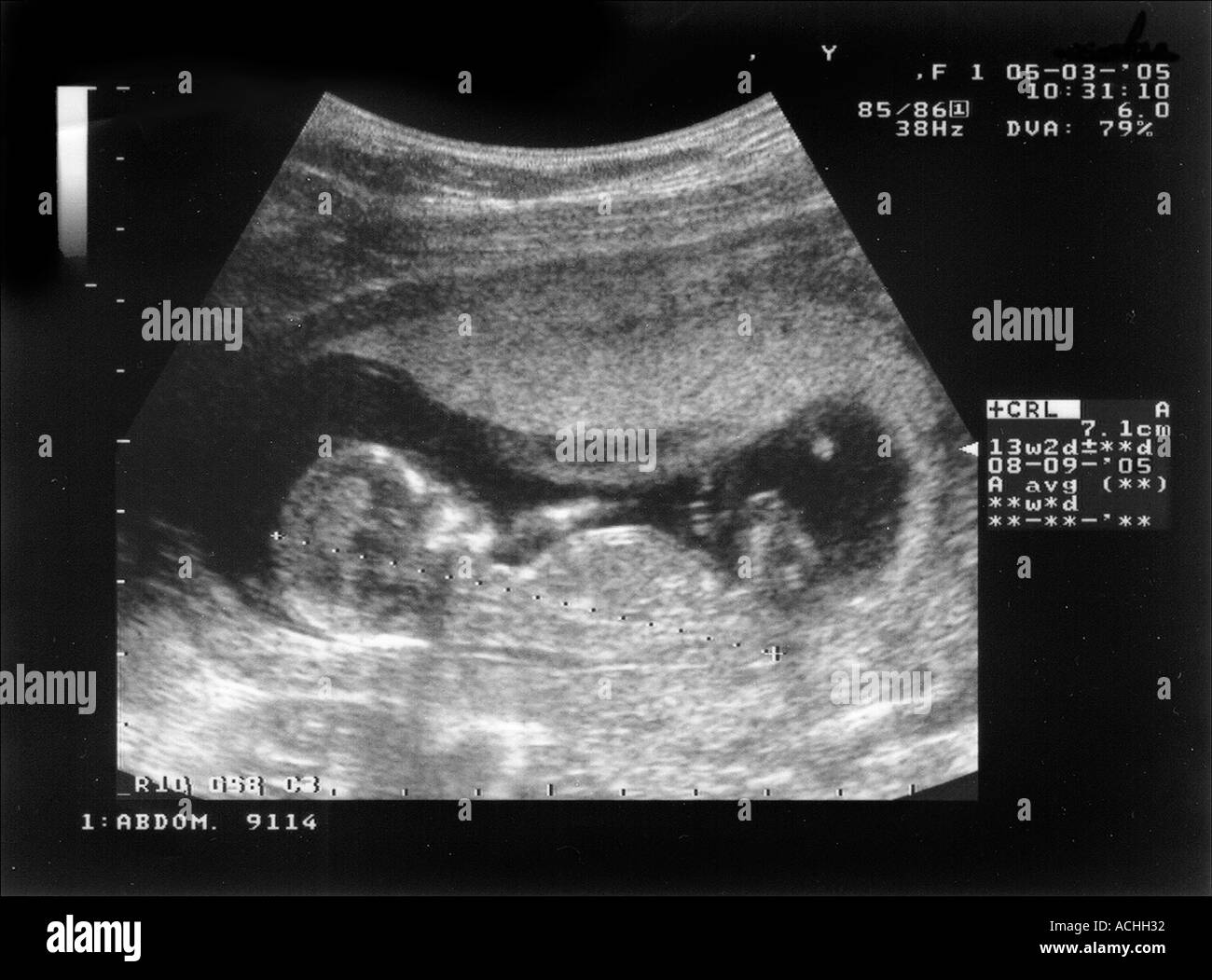 Embryo baby -Fotos und -Bildmaterial in hoher Auflösung – Alamy