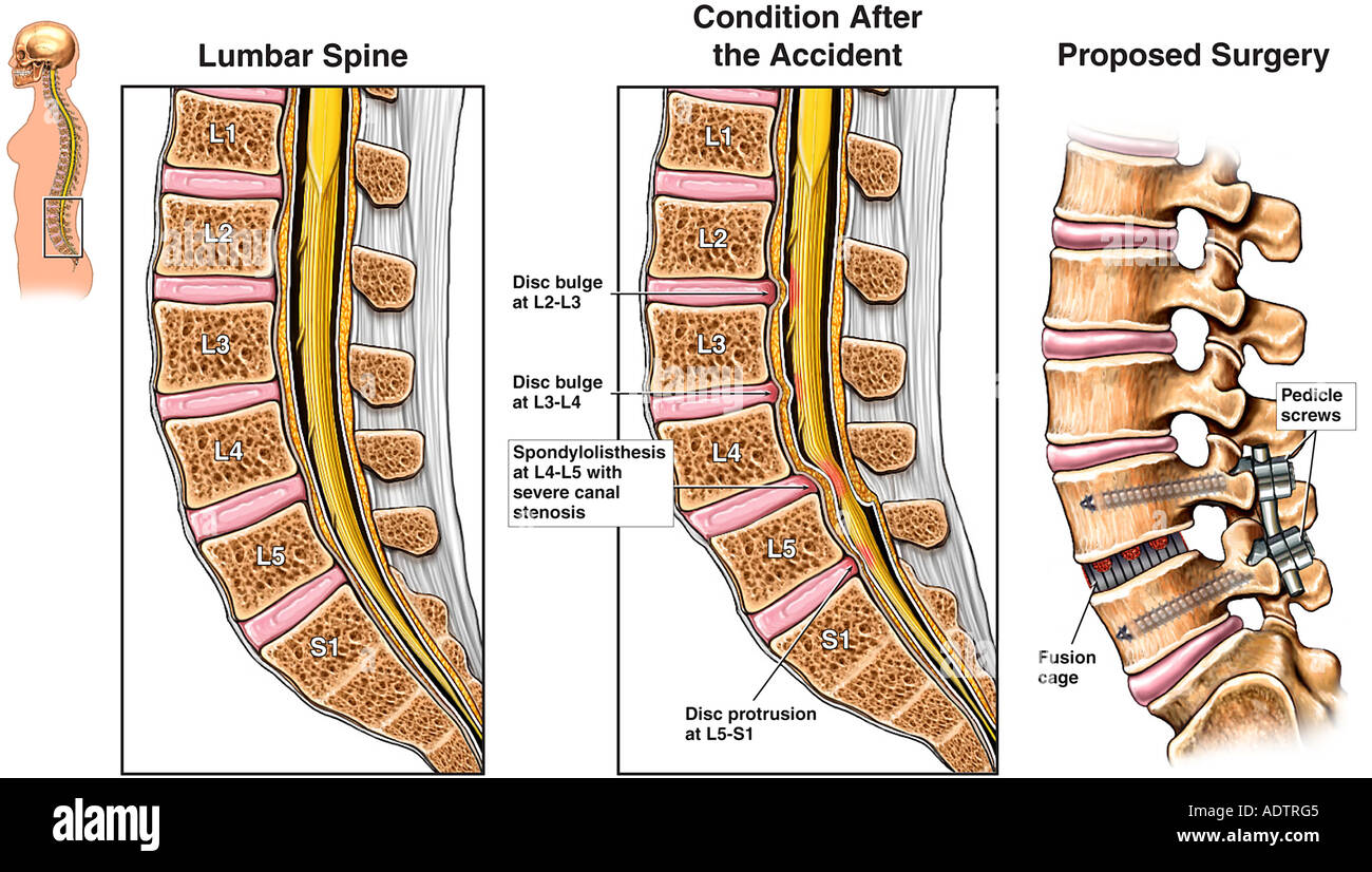 L3 l4 l4 l5 lumbar fusion -Fotos und -Bildmaterial in hoher Auflösung ...