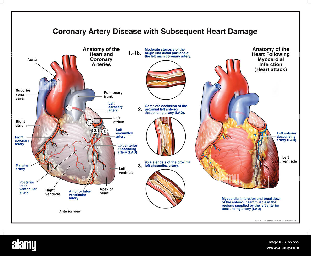 Koronare herzkrankheit -Fotos und -Bildmaterial in hoher Auflösung – Alamy