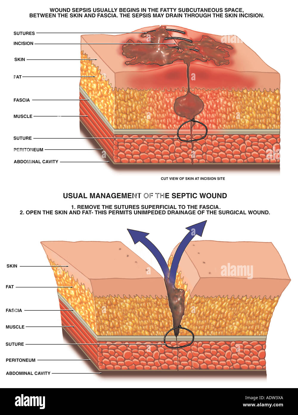 Postoperative infektion -Fotos und -Bildmaterial in hoher Auflösung – Alamy