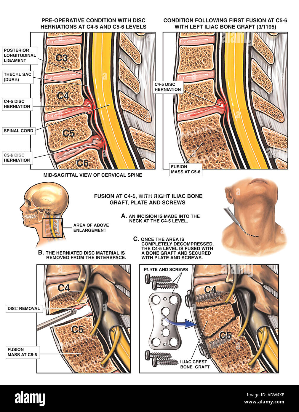 Cervical bone fusion -Fotos und -Bildmaterial in hoher Auflösung – Alamy
