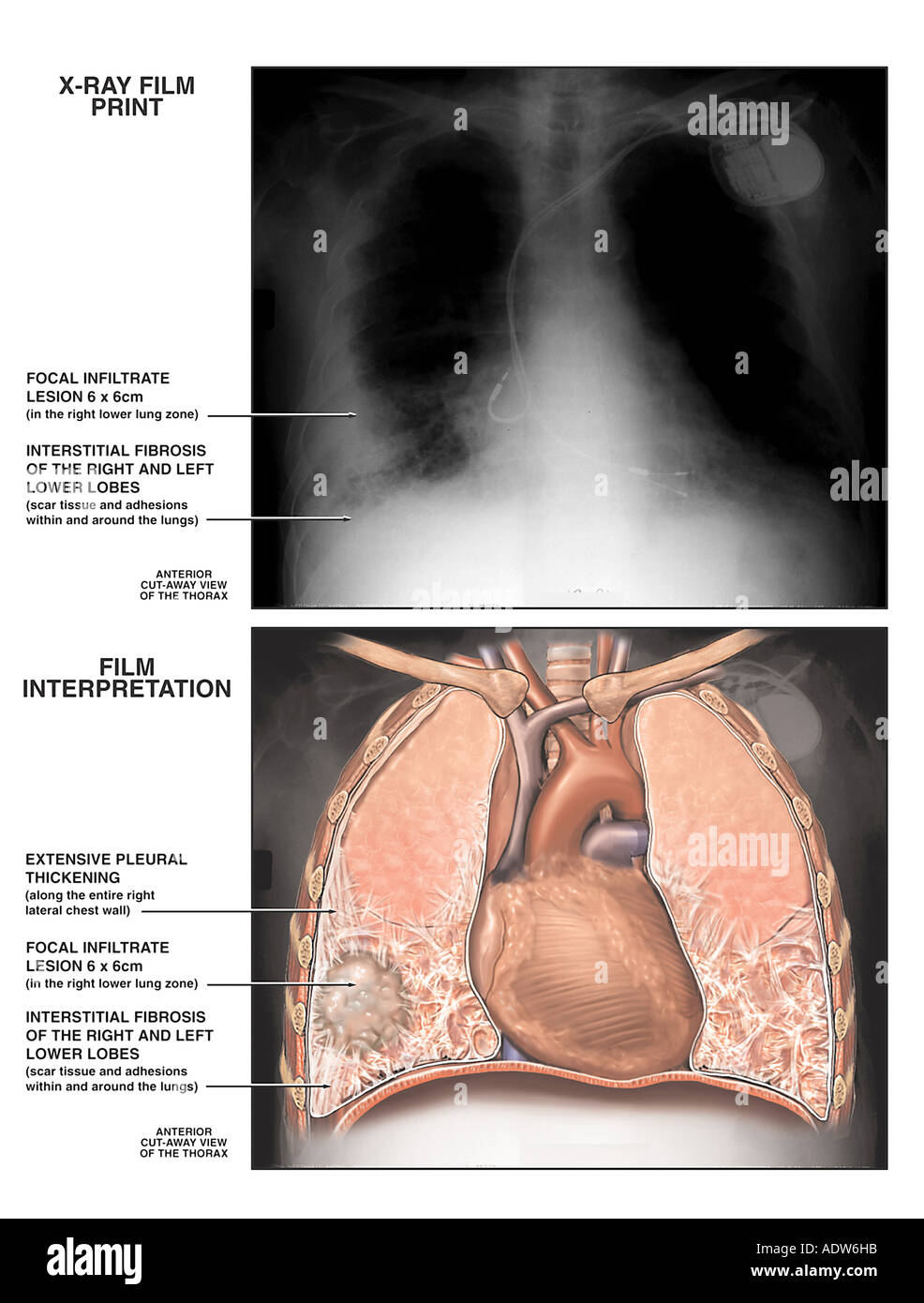 Asbestose der Lunge Stockfotografie - Alamy