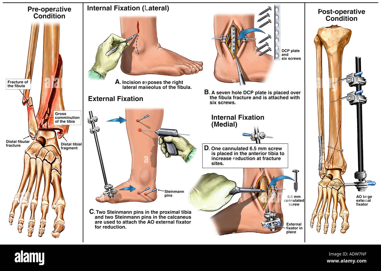 Richtige Sprunggelenksfrakturen mit nachfolgenden chirurgischen Fixierung und Platzierung von ...