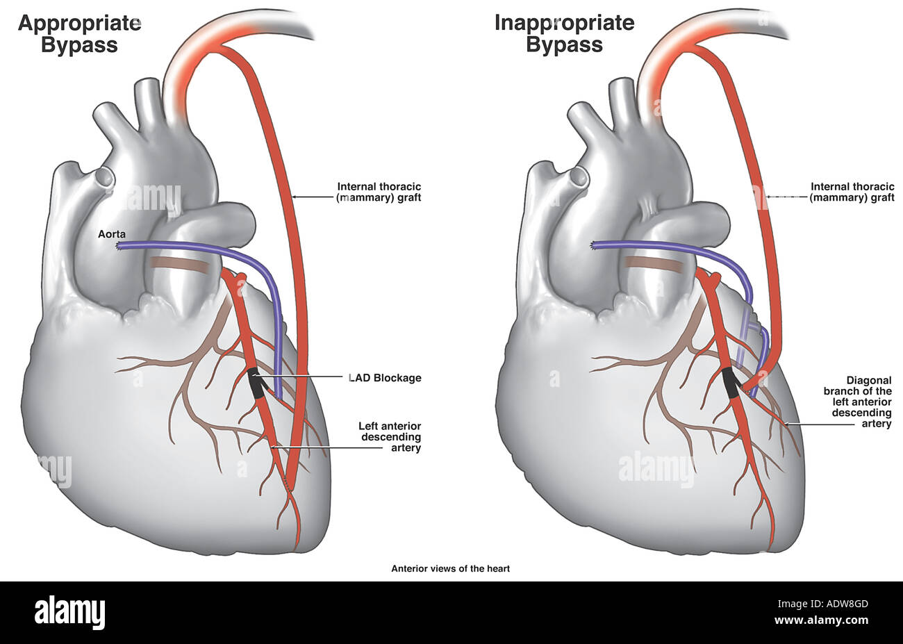 Bypass operation der herzkranzgefäße -Fotos und -Bildmaterial in hoher ...