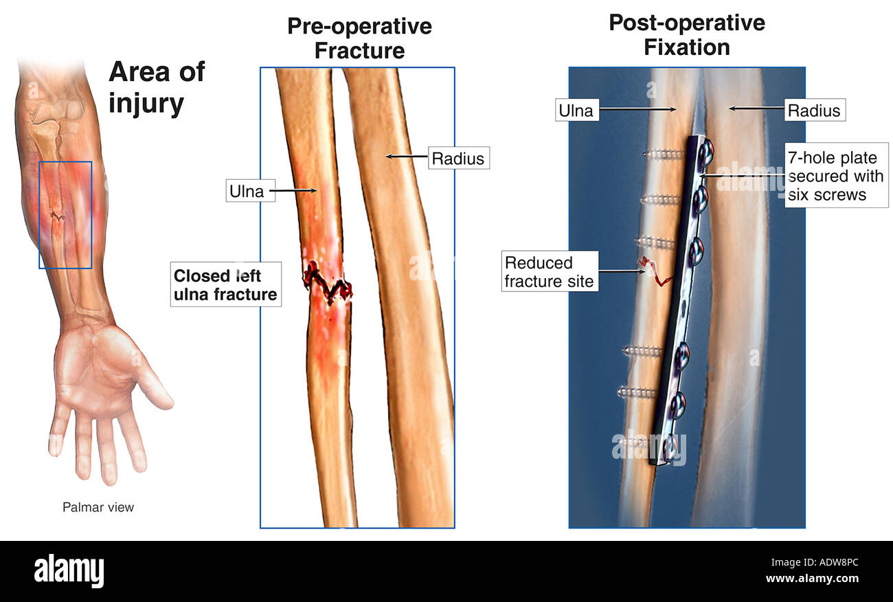 Ulna gebrochen -Fotos und -Bildmaterial in hoher Auflösung – Alamy