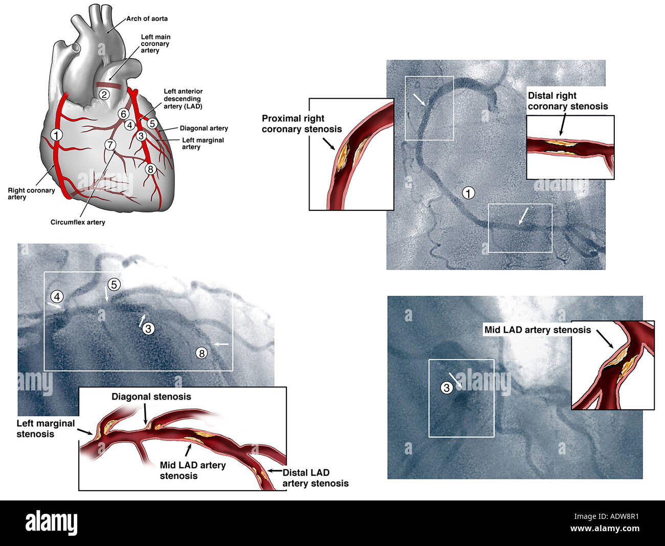 Coronary angiography -Fotos und -Bildmaterial in hoher Auflösung – Alamy