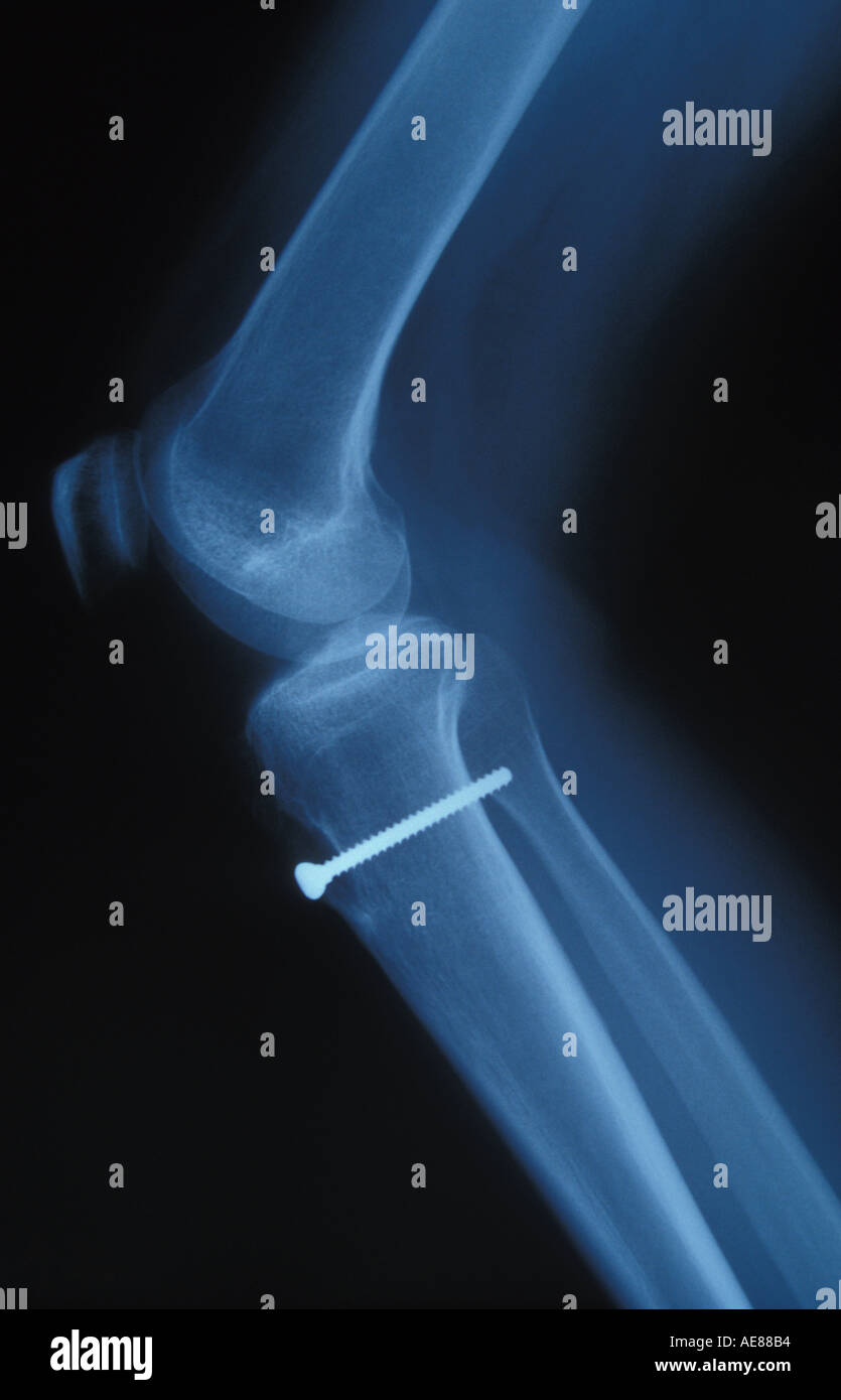 Das sind die tibia und die fibula -Fotos und -Bildmaterial in hoher ...