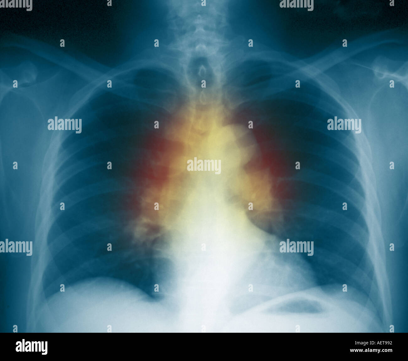 Brust-Xray eines Patienten mit Sarkoidose diagnostiziert ...