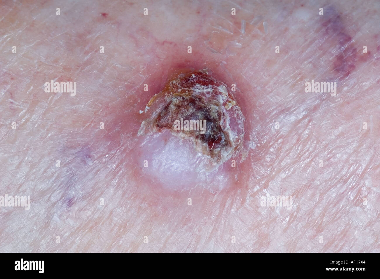 Atypisches fibroxanthom -Fotos und -Bildmaterial in hoher Auflösung – Alamy