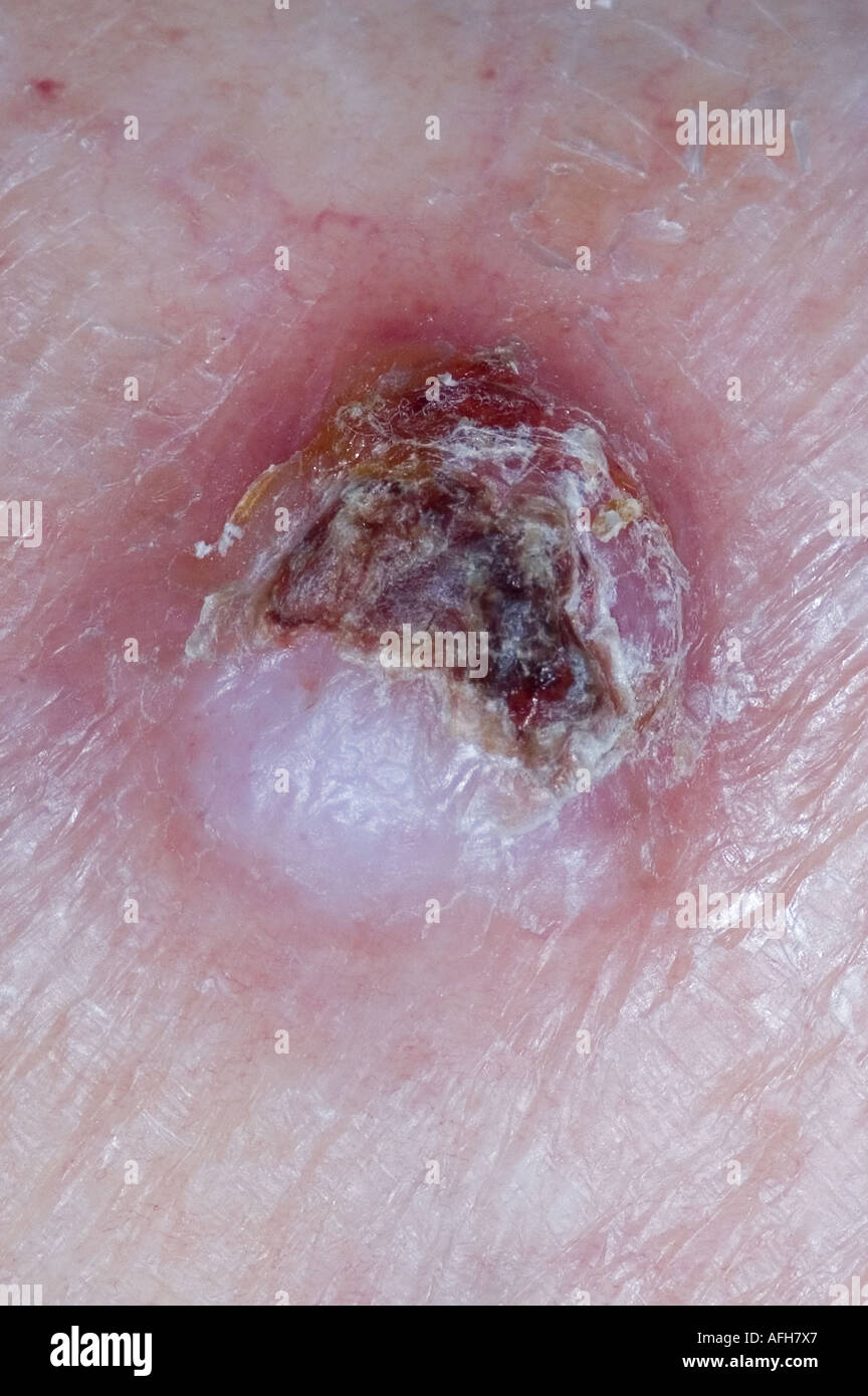 Atypisches fibroxanthom -Fotos und -Bildmaterial in hoher Auflösung – Alamy