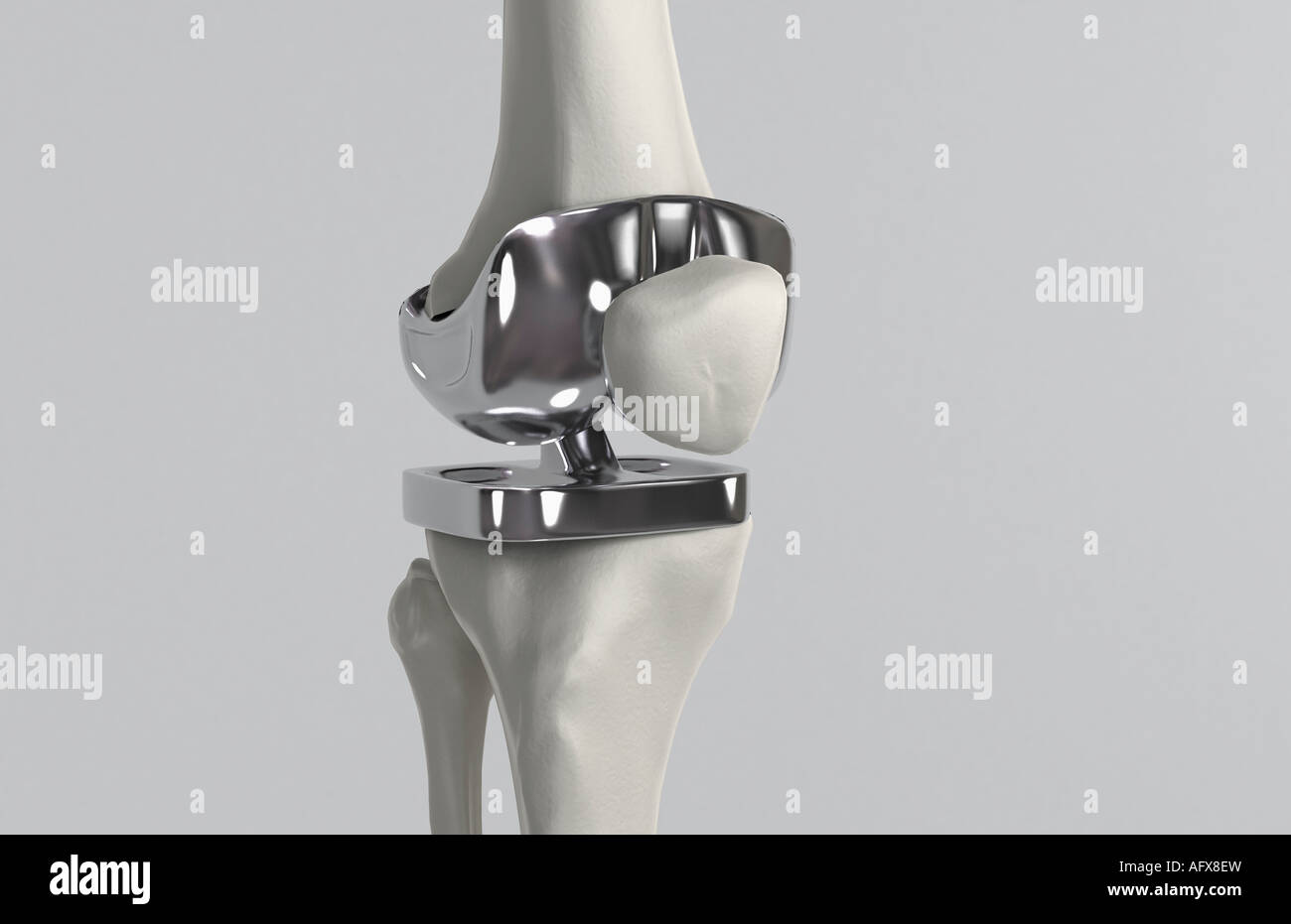 Knee Replacement Stockfotos & Knee Replacement Bilder - Seite 2 - Alamy
