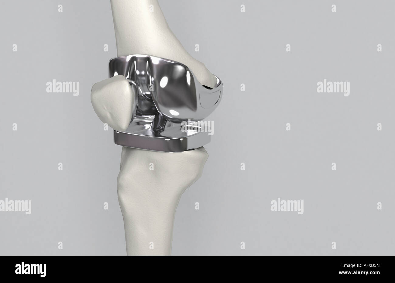 Knee Replacement Stockfotos & Knee Replacement Bilder - Seite 2 - Alamy