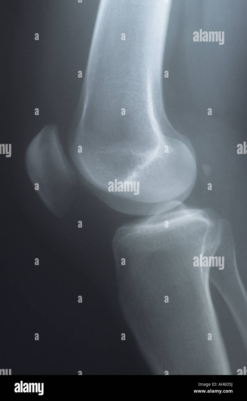 Kniescheibe röntgen -Fotos und -Bildmaterial in hoher Auflösung – Alamy