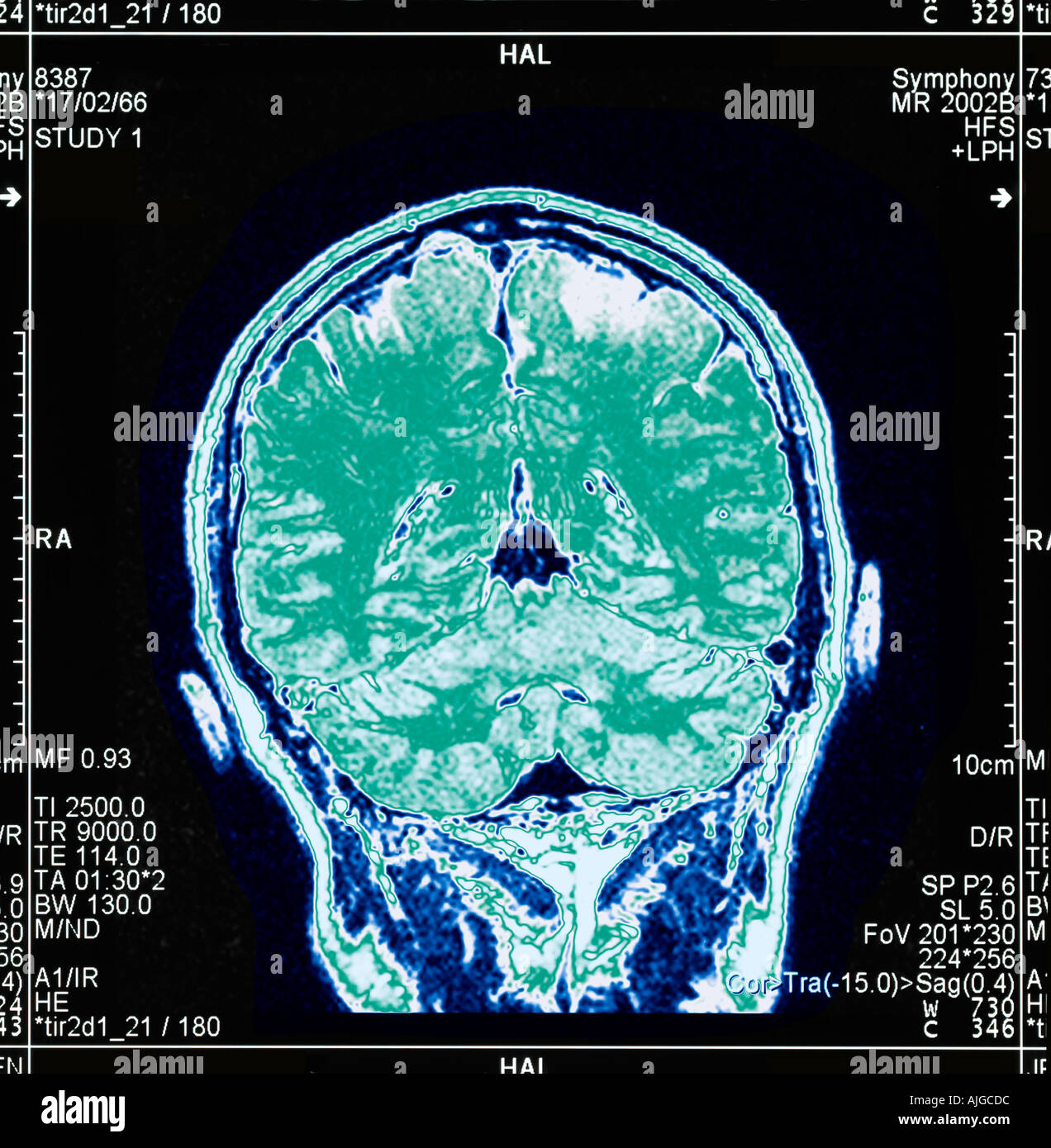 Mri magnetic resonance imaging -Fotos und -Bildmaterial in hoher ...