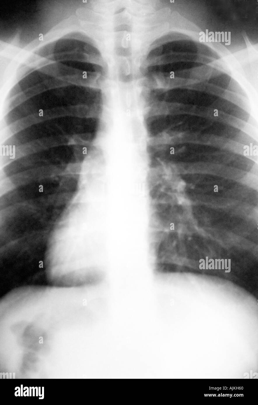Röntgenaufnahme des thorax -Fotos und -Bildmaterial in hoher Auflösung ...