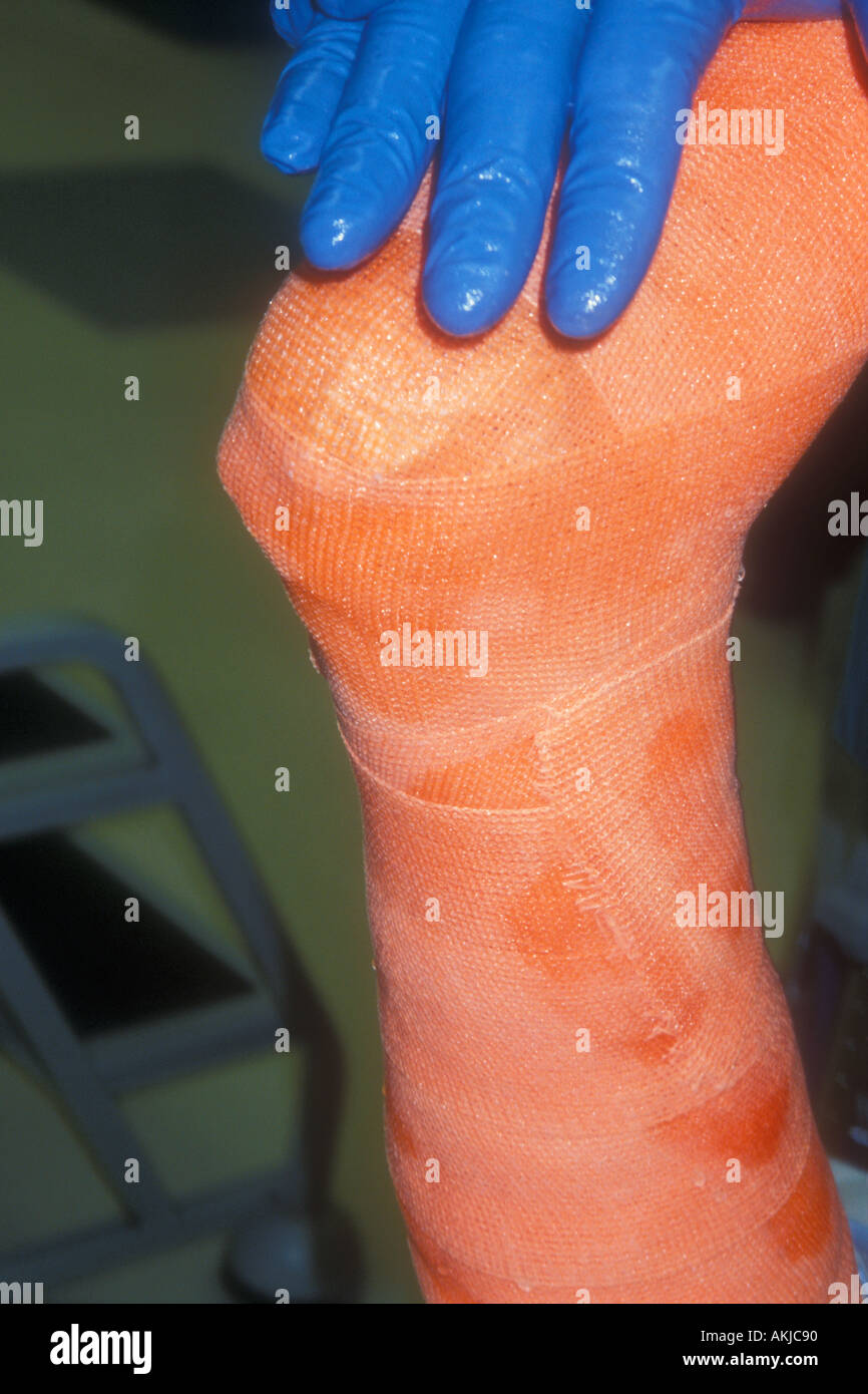 Bein gips krankenhaus -Fotos und -Bildmaterial in hoher Auflösung ...