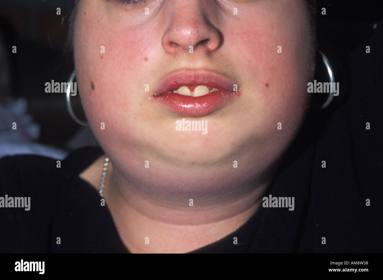 Mumps parotitis -Fotos und -Bildmaterial in hoher Auflösung – Alamy