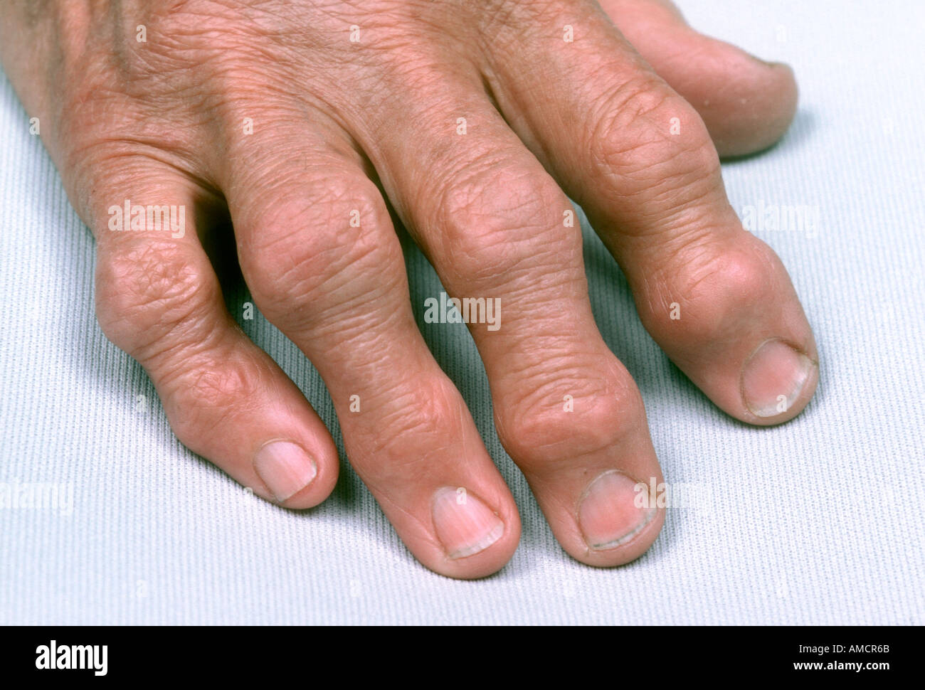 Arthrose hände -Fotos und -Bildmaterial in hoher Auflösung – Alamy
