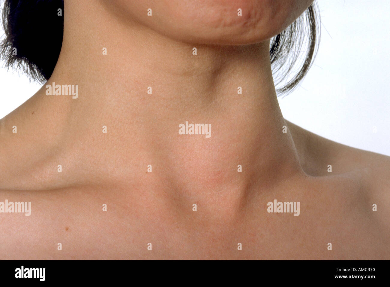 Thyroid goiter -Fotos und -Bildmaterial in hoher Auflösung – Alamy