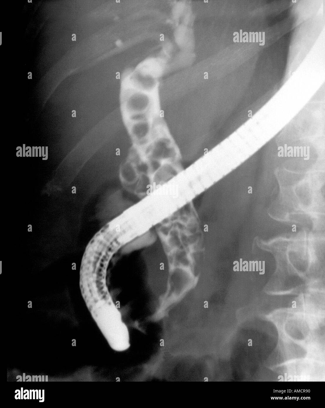 Ein Röntgenbild zeigt Gallensteine gemeinsam Galle duct Stockfotografie ...