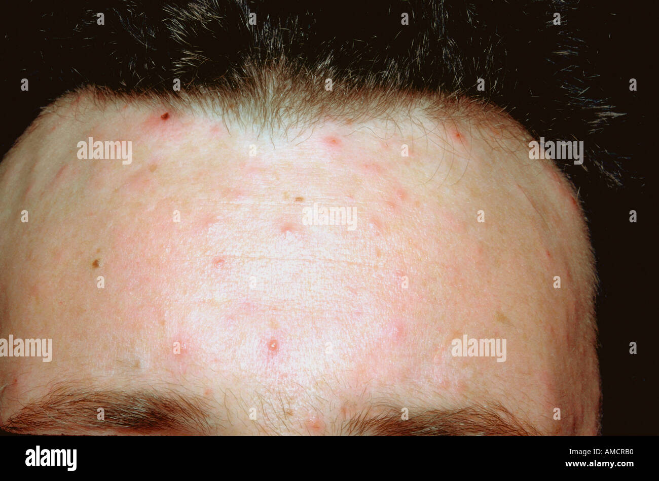 Ein Foto von der Stirn eines Mannes mit Windpocken, eine hochinfektiöse ...