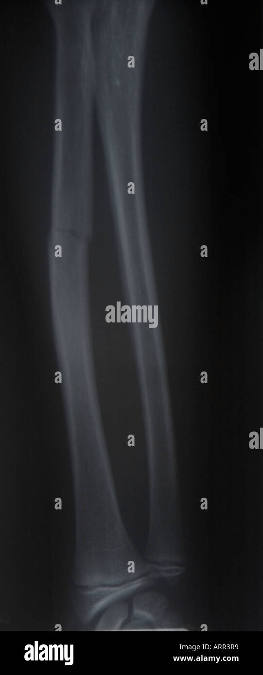 Greenstick fraktur -Fotos und -Bildmaterial in hoher Auflösung – Alamy
