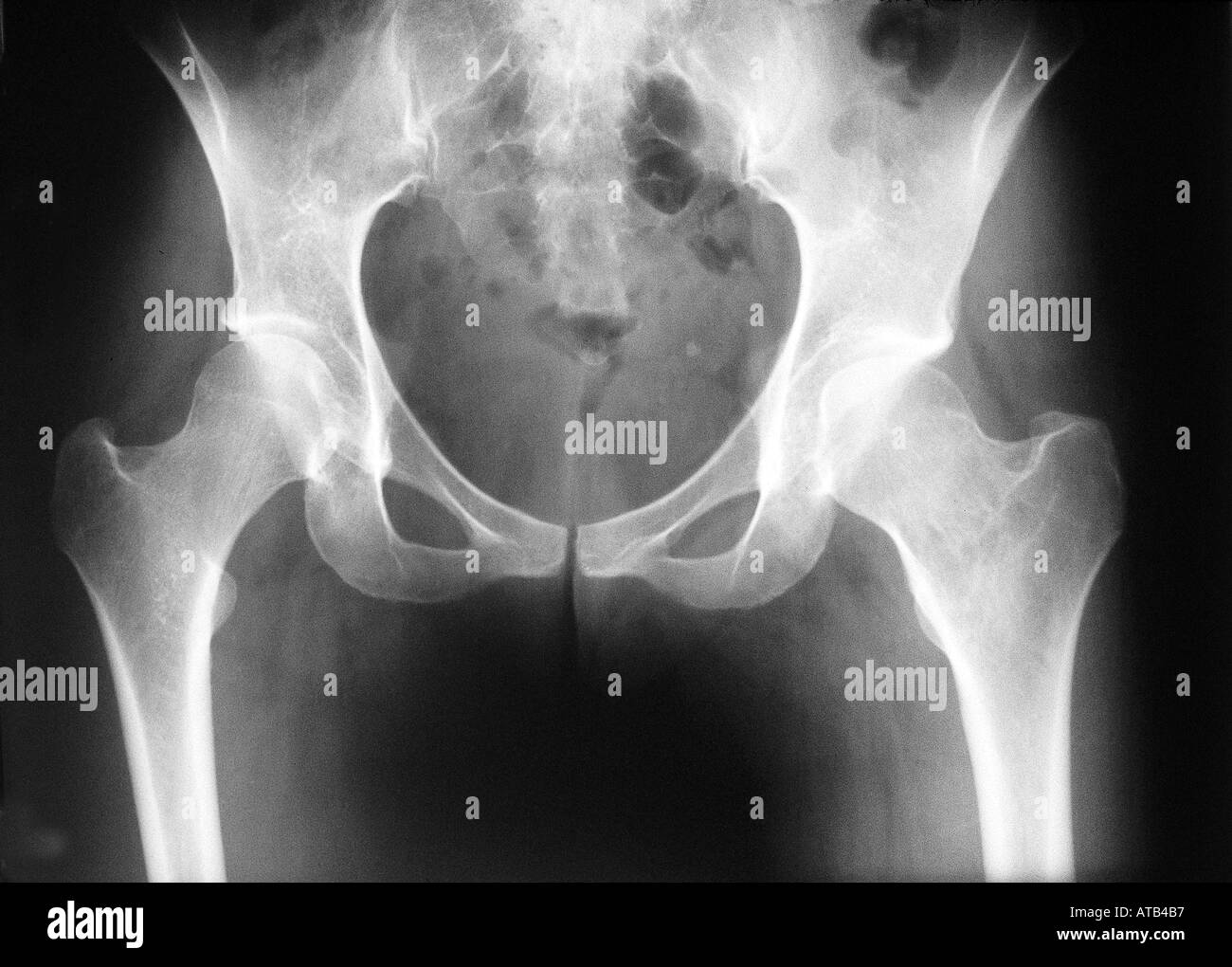 Normales becken -Fotos und -Bildmaterial in hoher Auflösung – Alamy