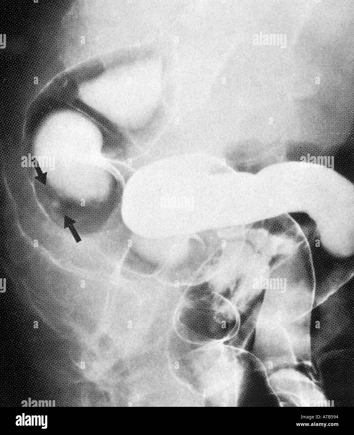 Intestinal polyp -Fotos und -Bildmaterial in hoher Auflösung – Alamy