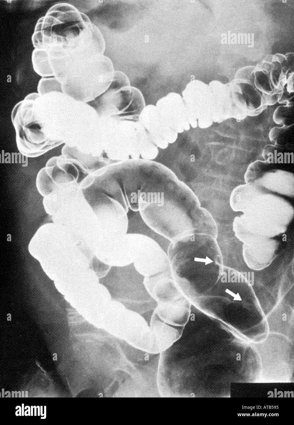 Intestinal polyp -Fotos und -Bildmaterial in hoher Auflösung – Alamy