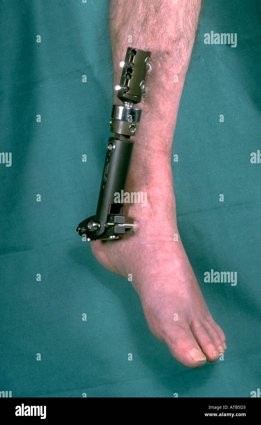 Fixateur externe Unterschenkel Stockfotografie - Alamy