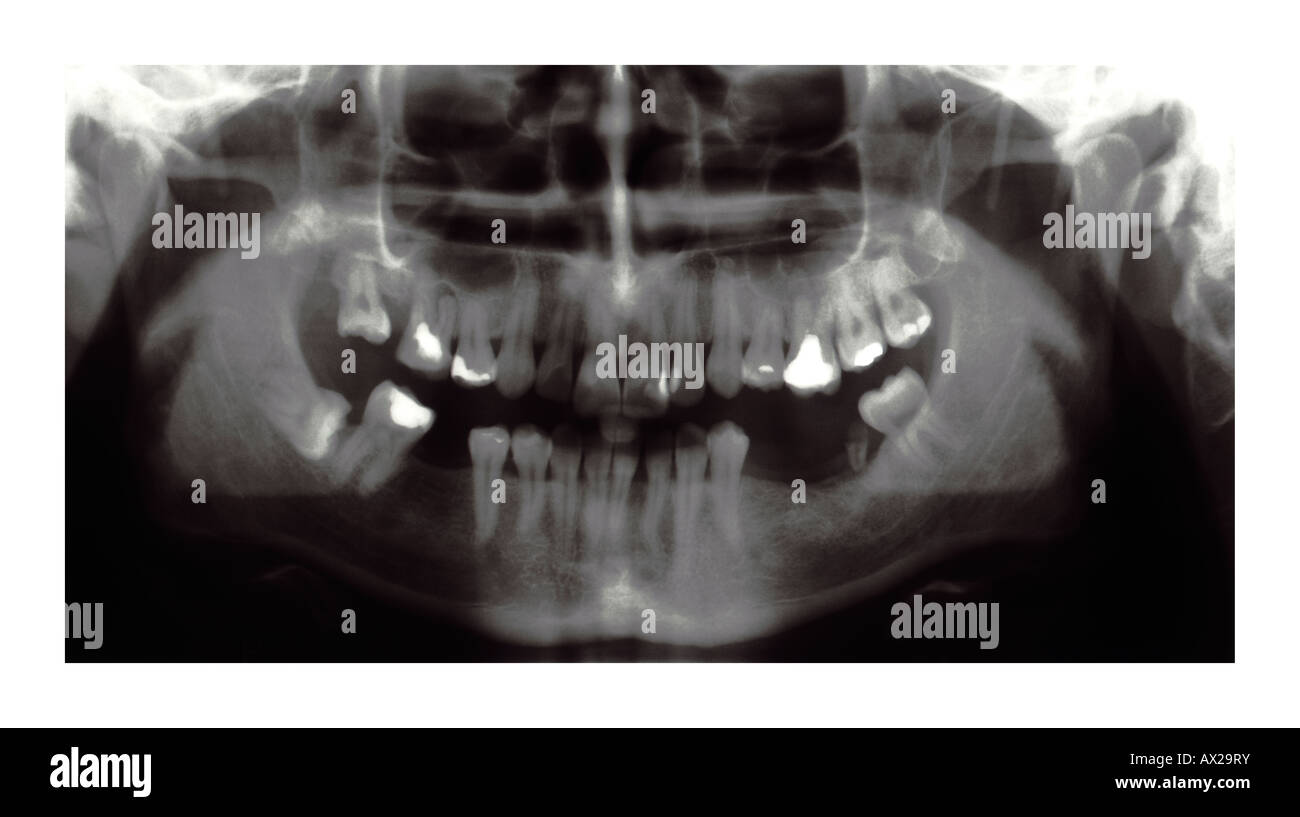 Orthopantomogram Opg Orthopantomogramm