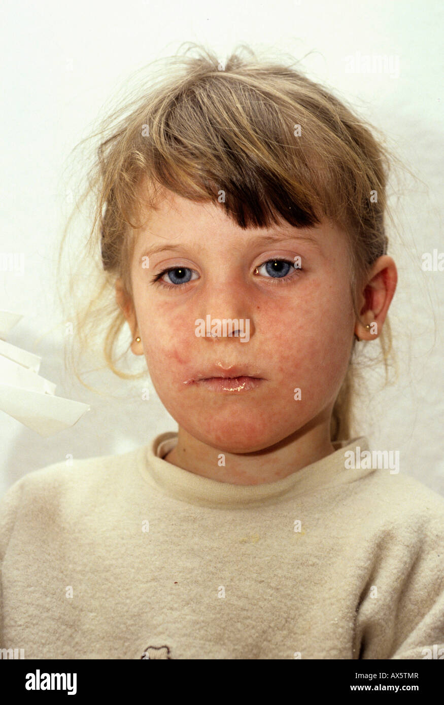 Kind mit masern -Fotos und -Bildmaterial in hoher Auflösung – Alamy