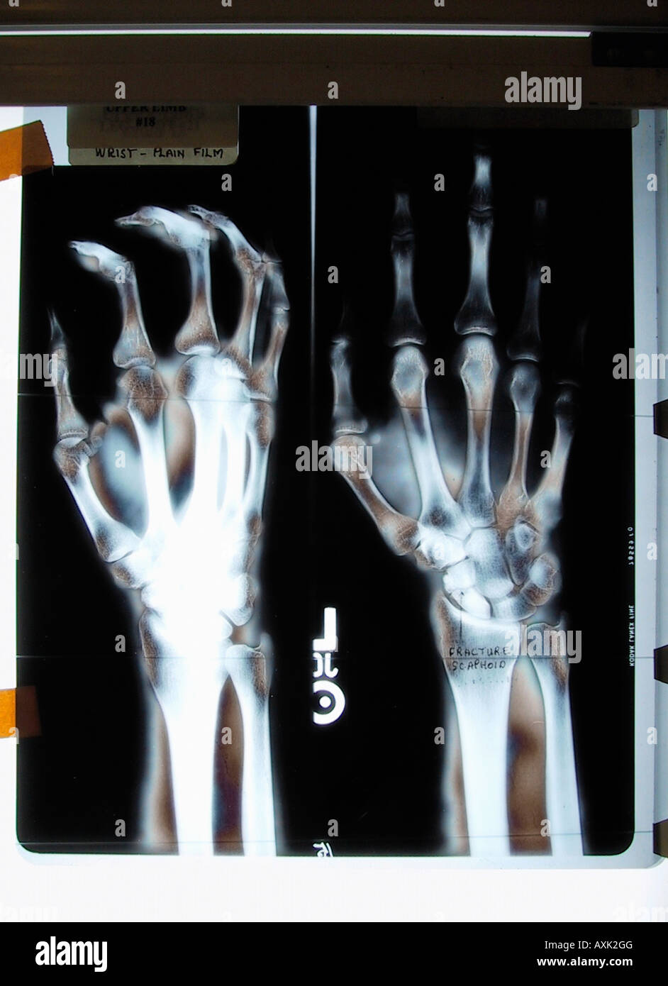 Arthritis hands xray -Fotos und -Bildmaterial in hoher Auflösung – Alamy