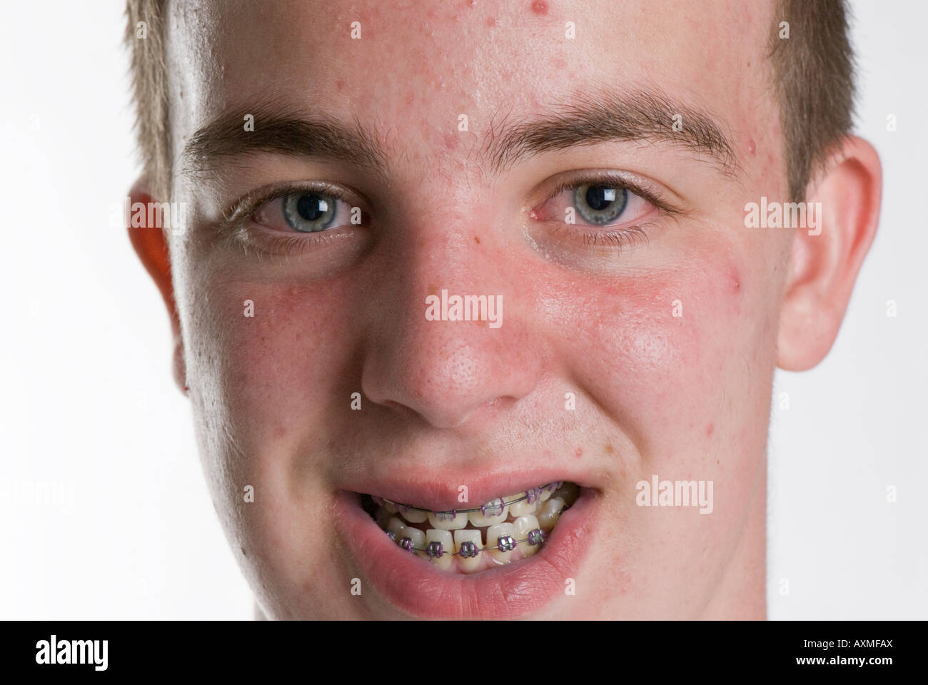 Teenage acne -Fotos und -Bildmaterial in hoher Auflösung – Alamy