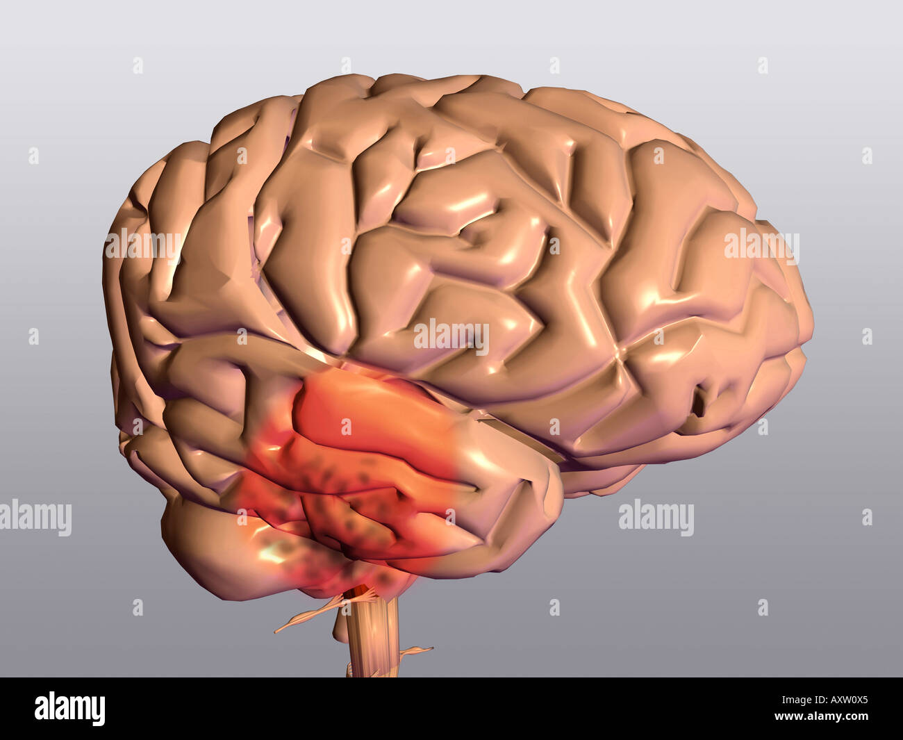 Parkinson disease -Fotos und -Bildmaterial in hoher Auflösung – Alamy