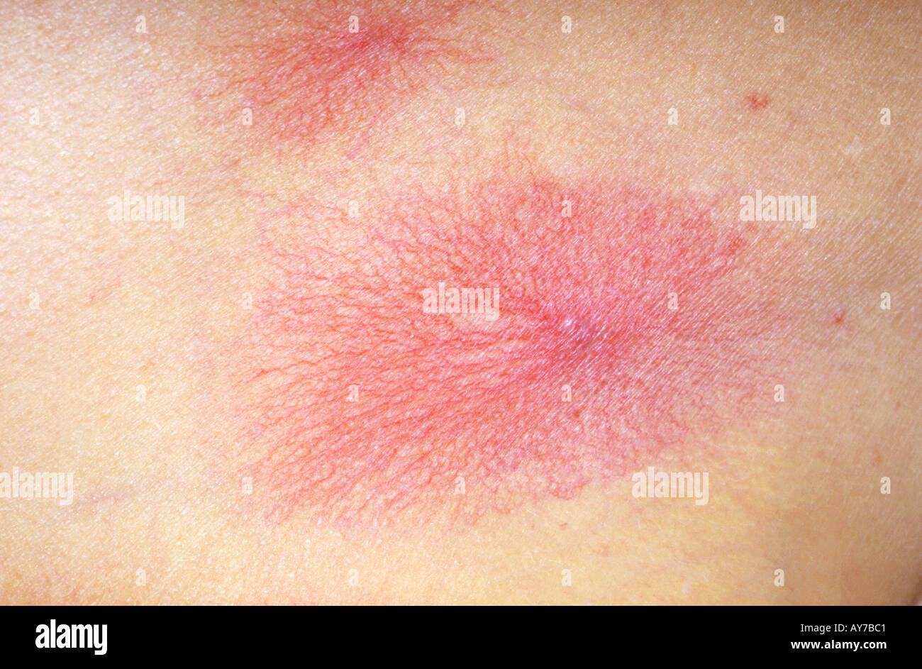 Spider naevus -Fotos und -Bildmaterial in hoher Auflösung – Alamy